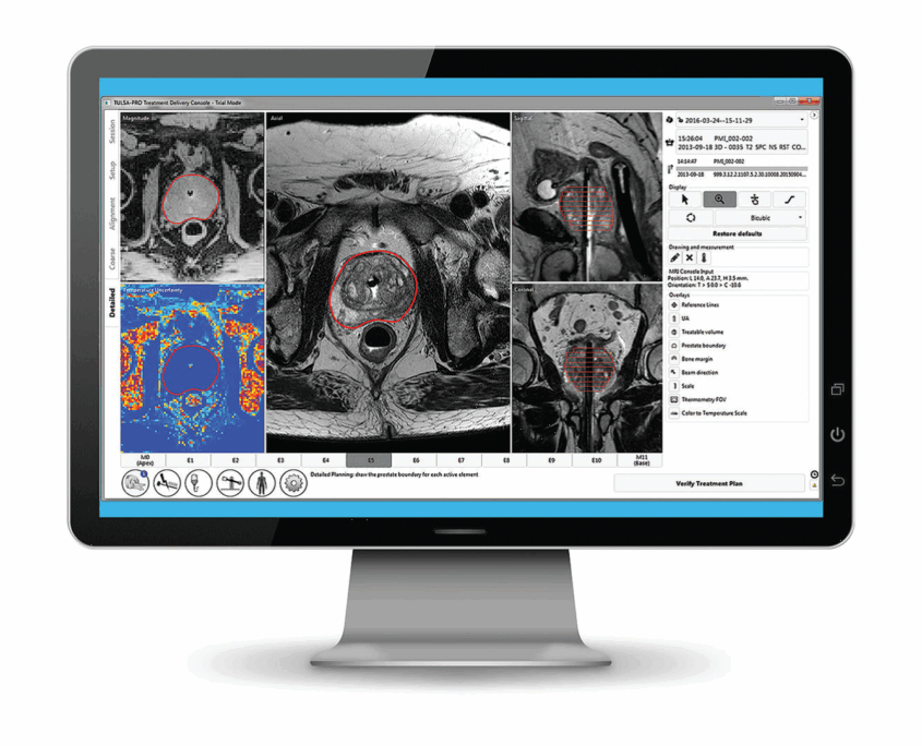 TULSA PRO - Profound Medical