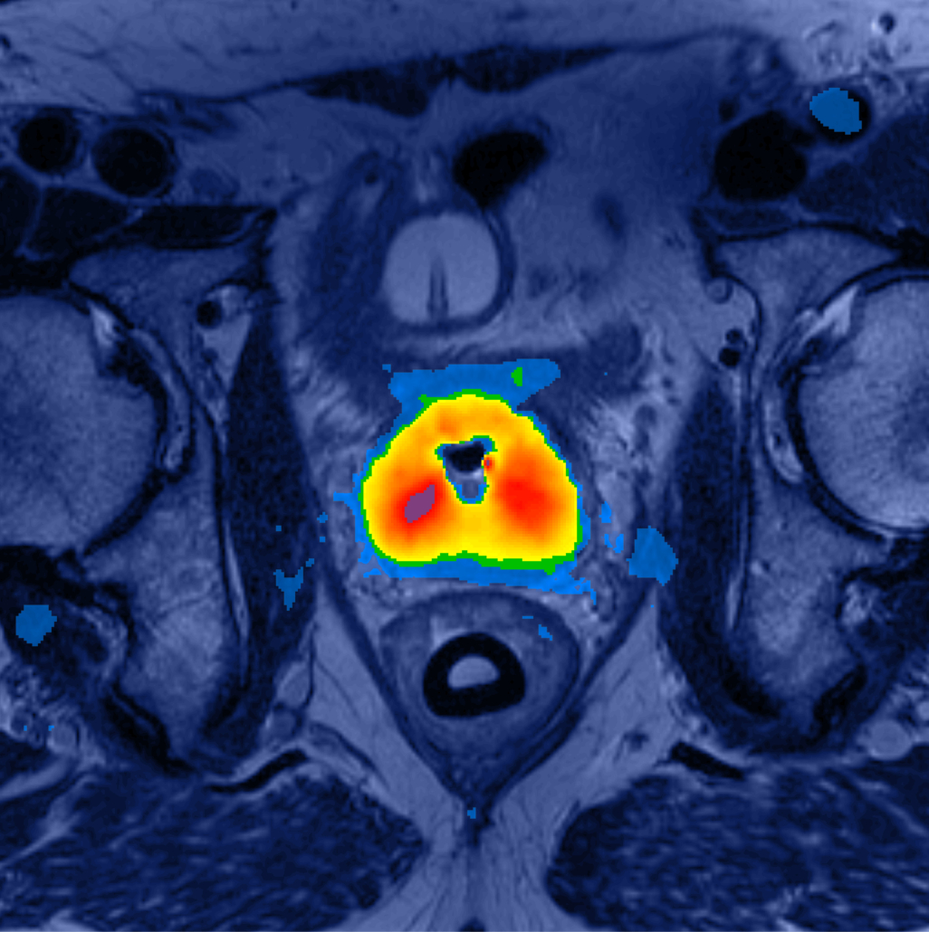 510k Clearance for TULSA-PRO - Profound Medical