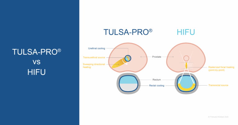 What is the difference between TULSA-PRO® and HIFU? - Profound Medical