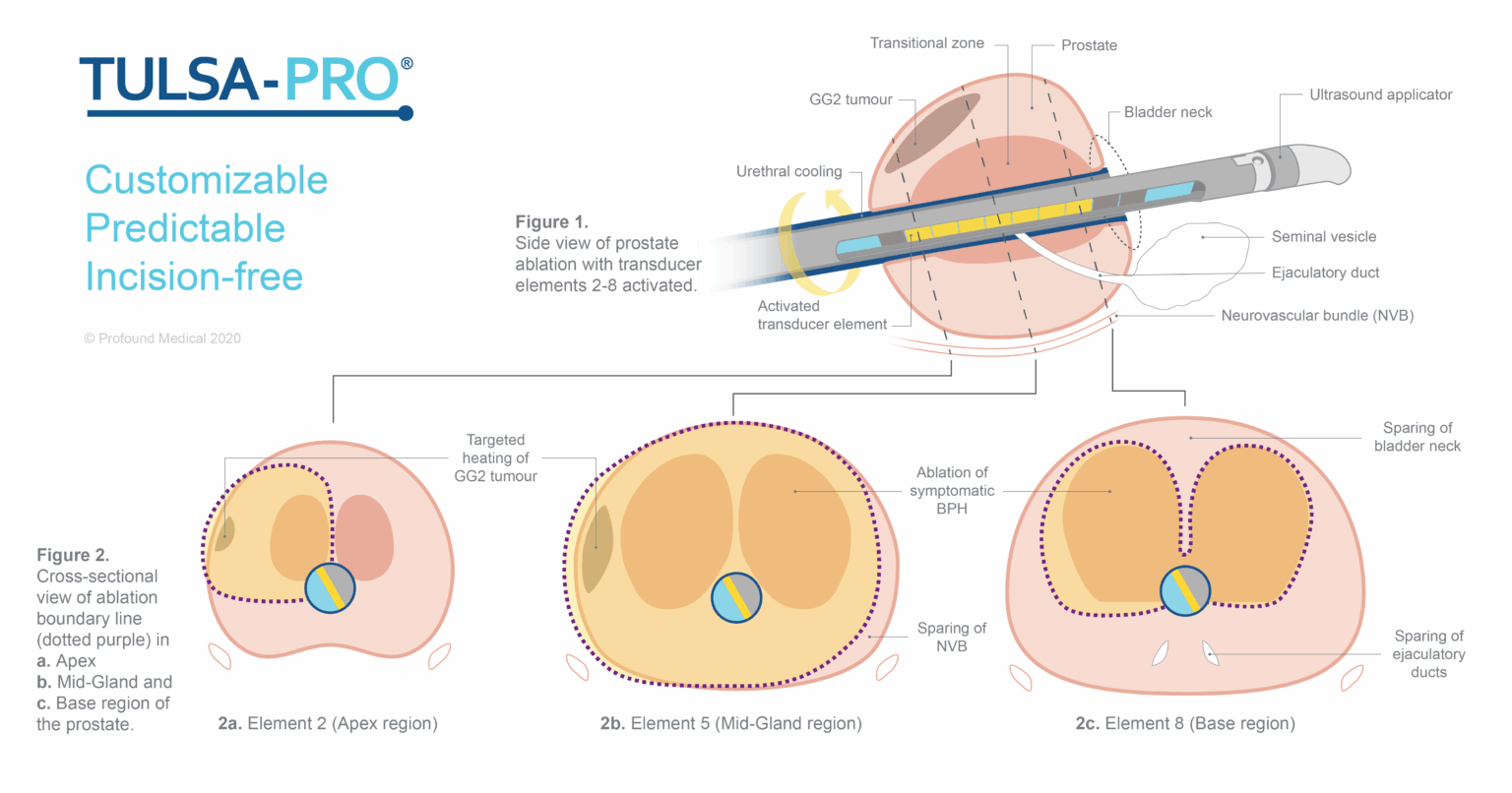 TULSA-PRO® is Versatile by Design - Profound Medical