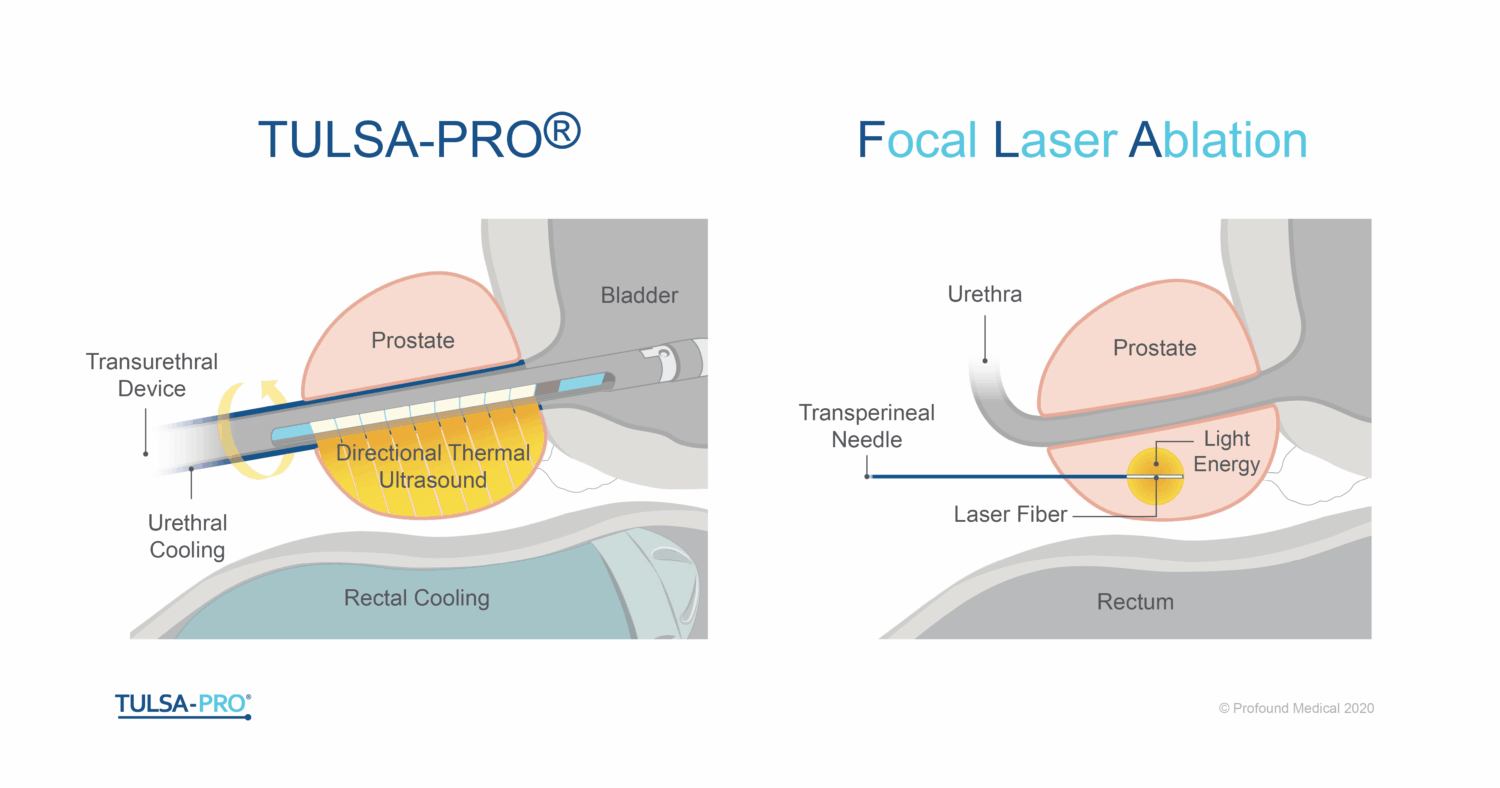 TULSA-PRO and FLA - Profound Medical